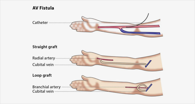 Dialysis Fistula Vs Graft Dialysis Fistula Vs Graft